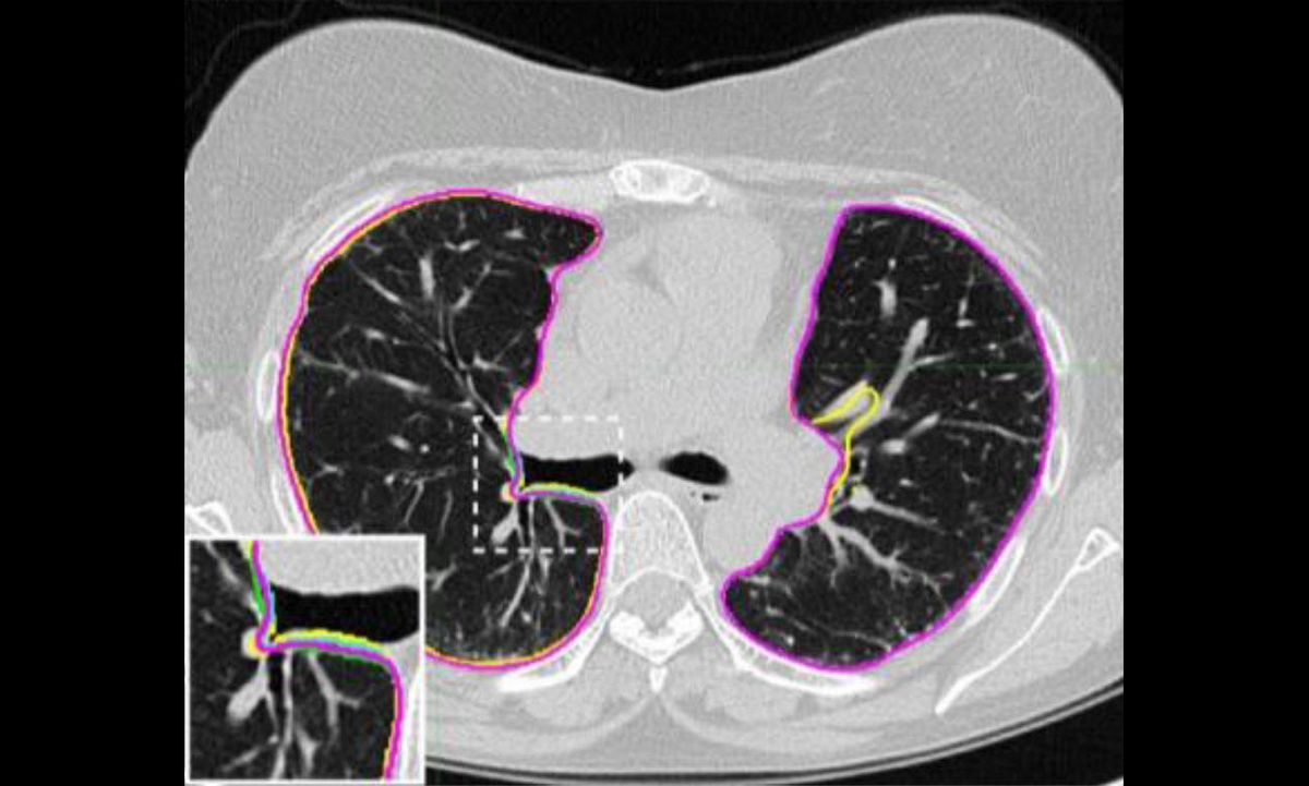 Radiomics / Lungenfibrose: Zuverlässige Prognose dank KI - Radiologie