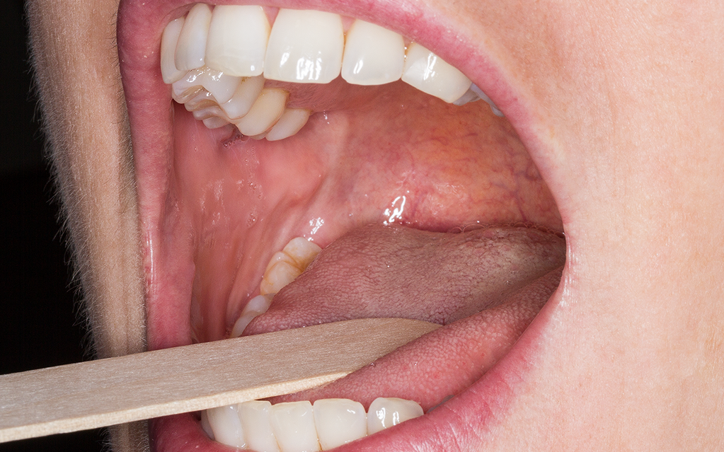 Mundhöhlenkrebs lässt sich vermeiden - Radiologie